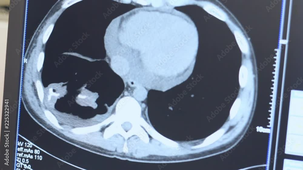 Magnetic resonance image of patient body on monitor. High technology ct ...