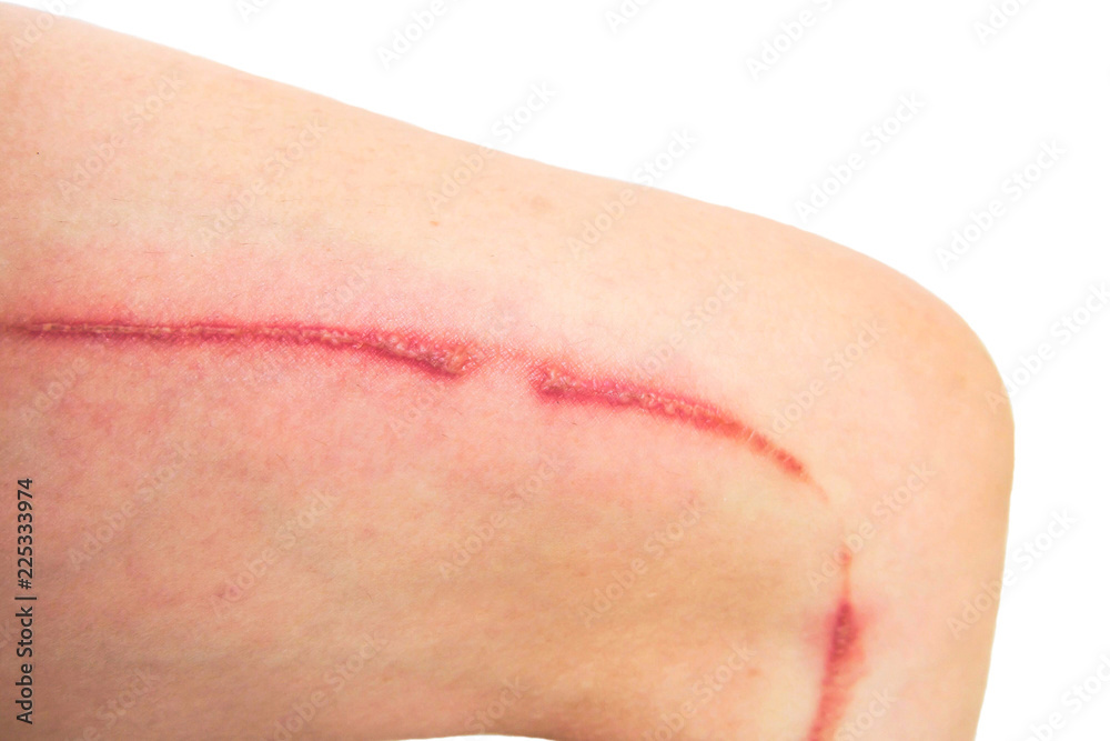 Blisters caused by rove beetles (Paederus fuscipes Curtis) on thigh ...