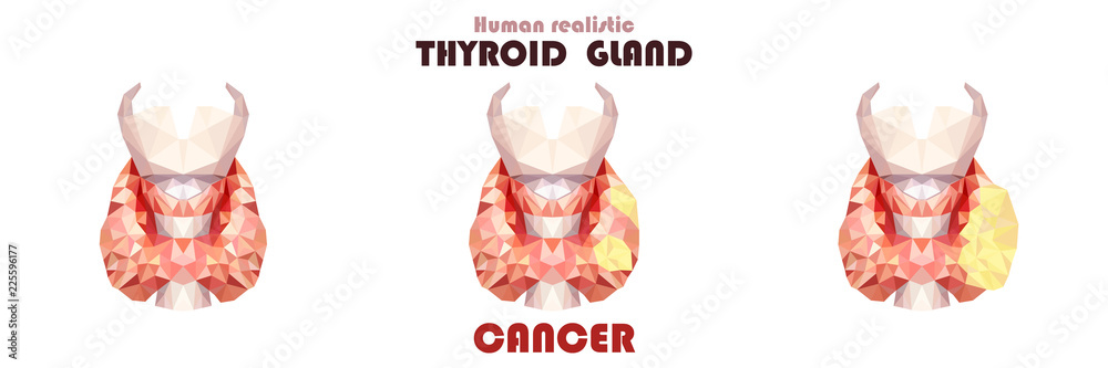 Realistic thyroid gland in low poly. Inflammation cancer Human 3d ...
