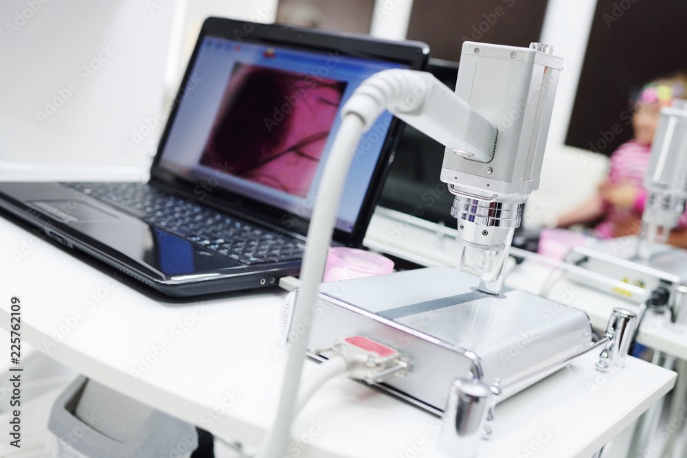 Image of a birthmark or warts close-up on a laptop monitor. Dermatology ...