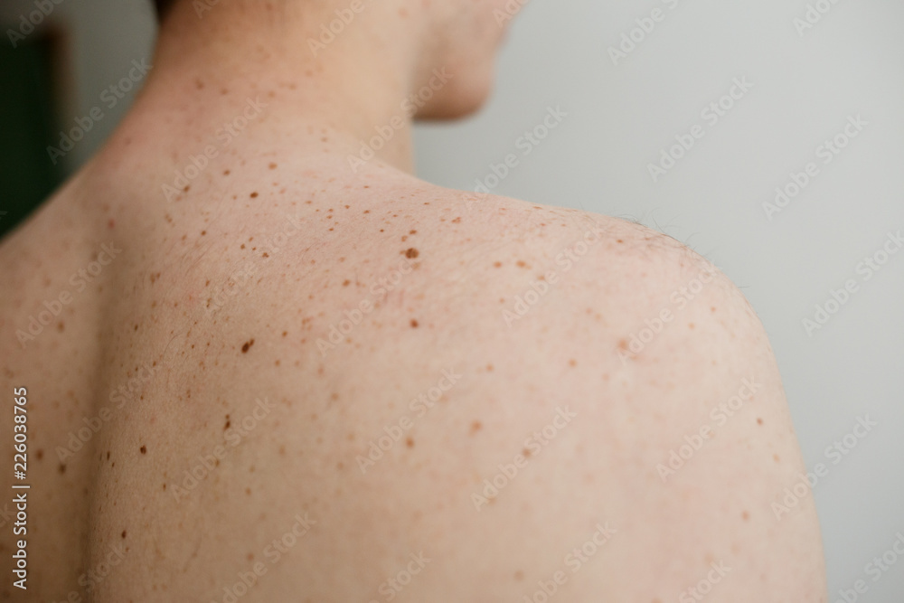 Close up detail of the bare skin on a man back with scattered moles and ...