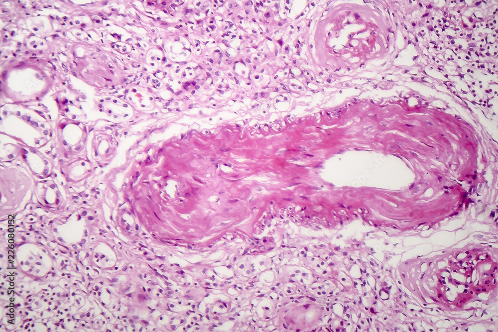 Contracted kidney, light micrograph, photo under microscope Stock Photo ...