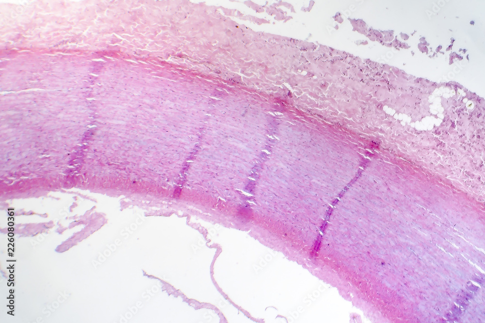 Foto de Fibrinoid necrosis of the vessel wall, light micrograph, photo ...