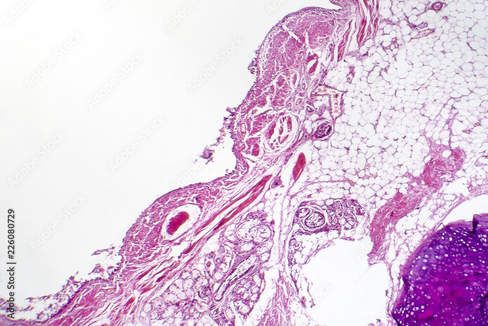 Chronic bronchitis, photo under microscope, light micrograph Stock ...