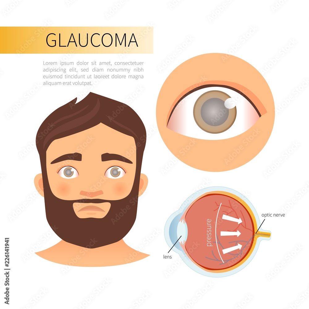 Glaucoma infographics. A young man with glaucoma. The structure of the ...