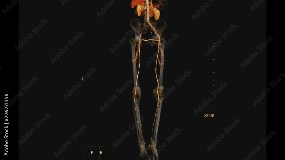 CT SCAN of lower extremity with contrast media injection shown vessels ...
