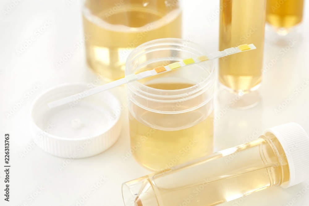 Urine samples for analysis and test strip Stock Photo | Adobe Stock