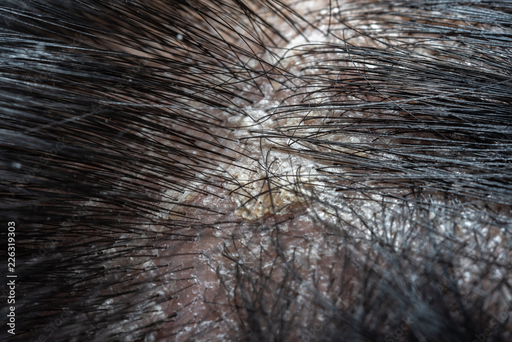 Hair scalp with dandruff and scaly from psoriasis Stock Photo | Adobe Stock