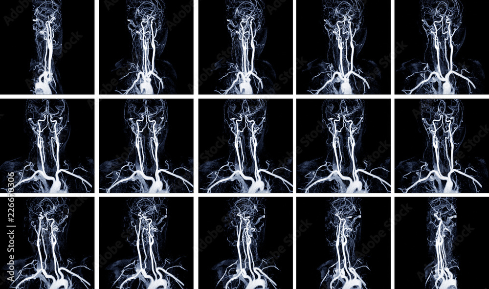 MRA Brain (Magnetic Resonance Angiography)of the blood vessels in the ...
