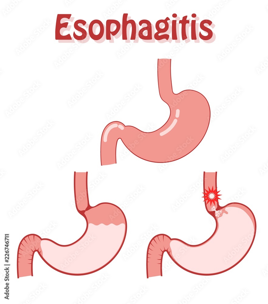 Human stomach in a flat style on a white background. Disease ...