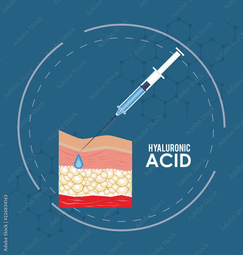 hyaluronic acid filler injection infographic Stock Vector | Adobe Stock