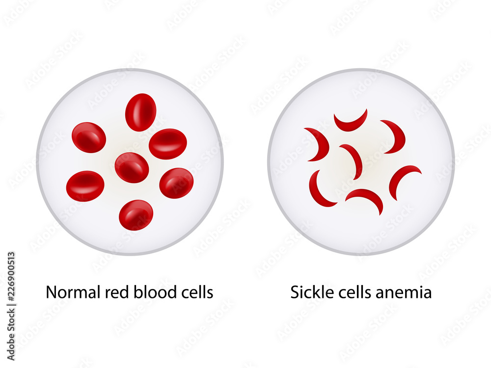 Comparison between Normal red blood cells and Sickle cells anemia Stock ...