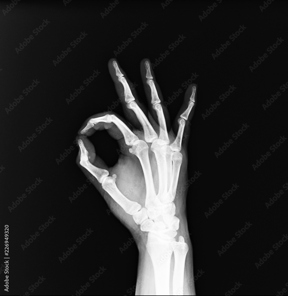 X-ray of the hands Stock Photo | Adobe Stock