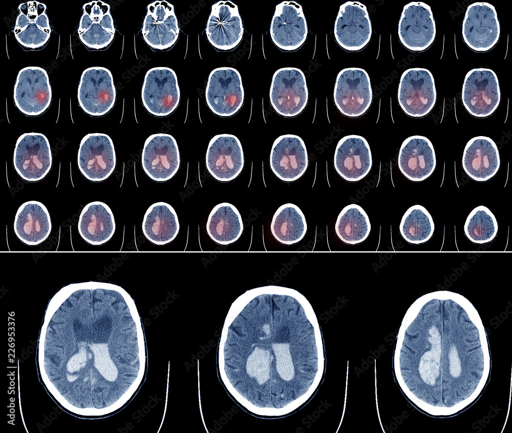 Computed Tomography (CT or Cat) scan of the brain a male 78 year old ...