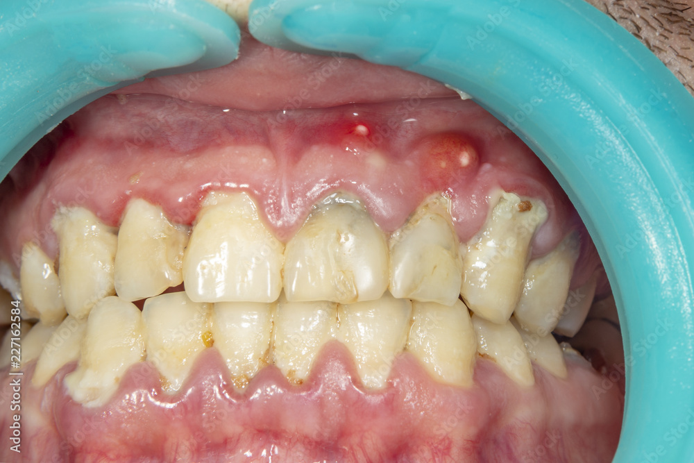 Human teeth closeup with dental plaque and inflammation of gingivitis ...