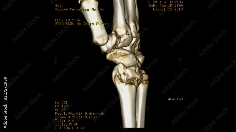 Ct scan 3D rendering image and 2D coronal and sagittal view of wrist ...