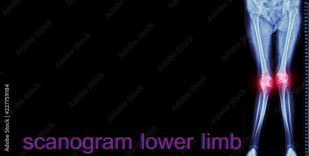 scanogram of lower limb. Medical background. Stock Photo | Adobe Stock