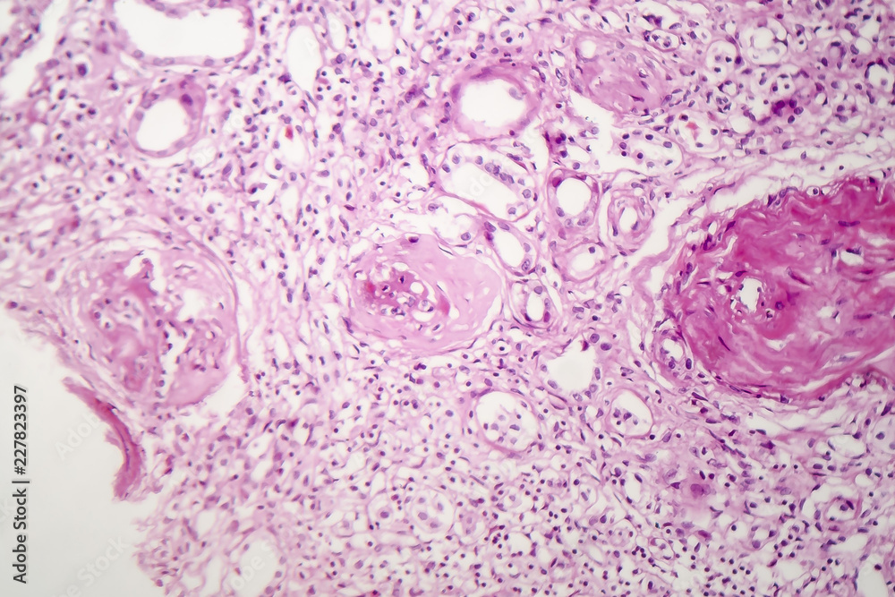 Contracted kidney, light micrograph, photo under microscope Stock Photo ...