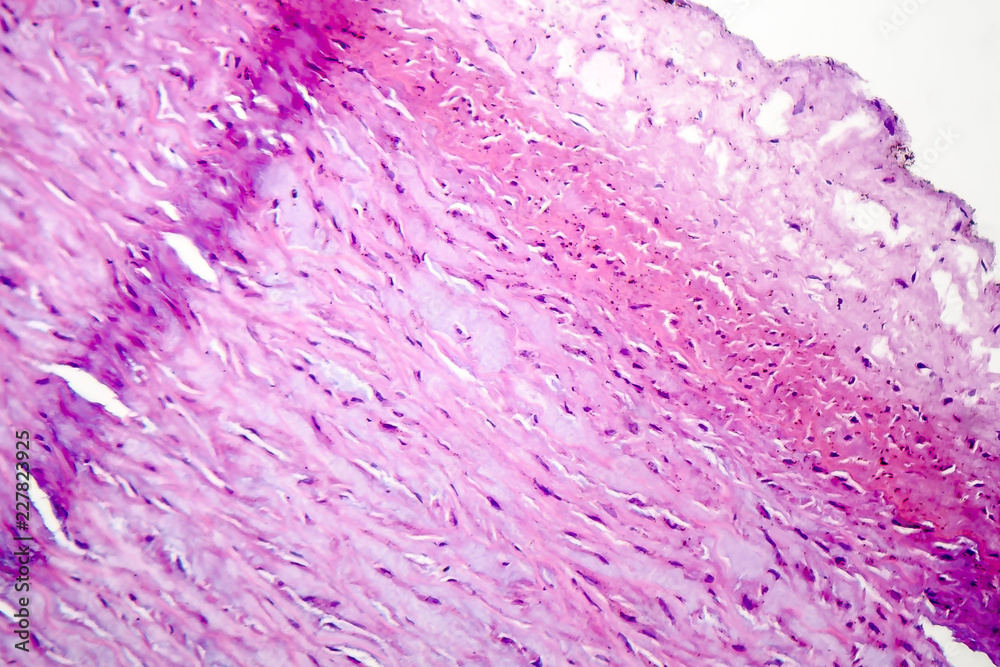 Fibrinoid necrosis of the vessel wall, light micrograph, photo under ...