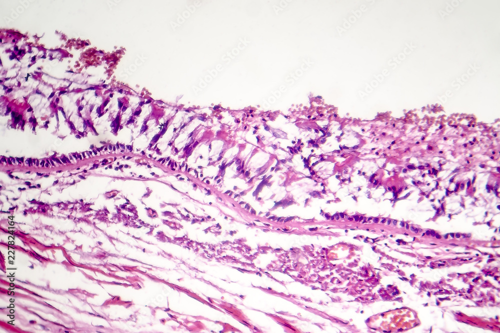 Chronic bronchitis, photo under microscope, light micrograph Stock ...