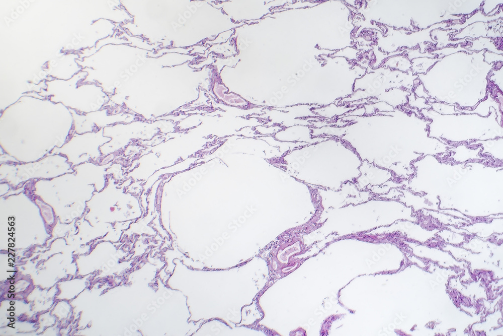 Diffuse lung emphysema, light micrograph, photo under microscope Stock ...