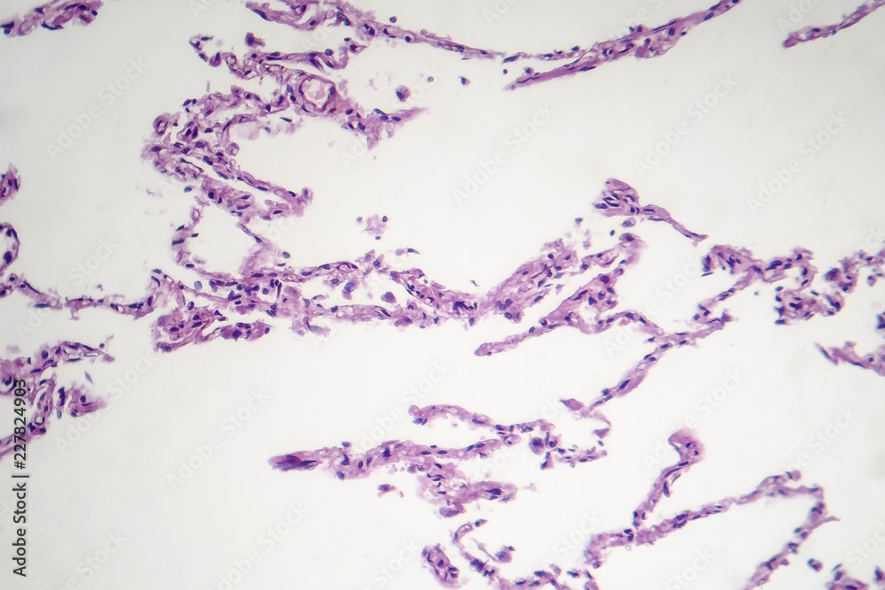 Diffuse lung emphysema, light micrograph, photo under microscope Stock ...