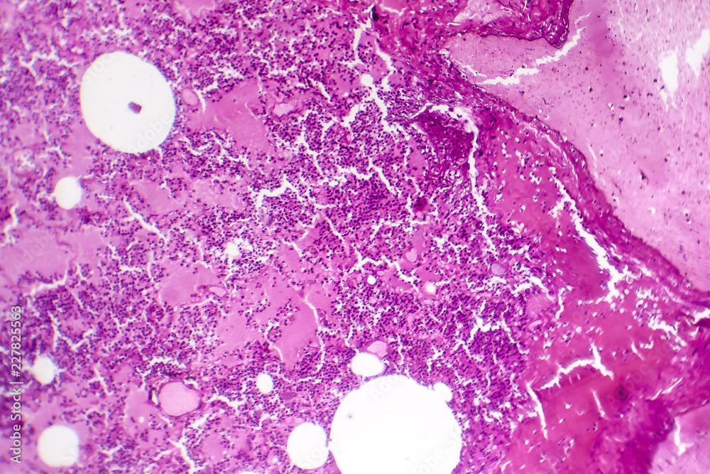 Lobar pneumonia, hemorrhagic edema period, light micrograph, photo ...