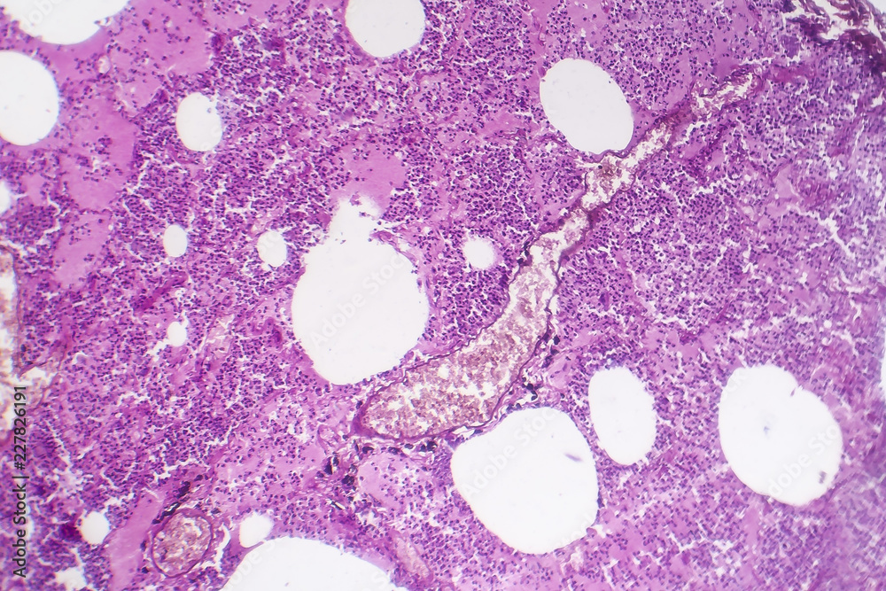 Lobar pneumonia, hemorrhagic edema period, light micrograph, photo ...