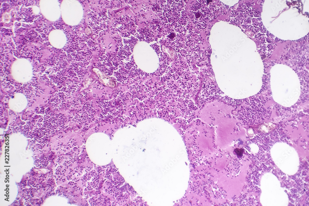 Lobar pneumonia, hemorrhagic edema period, light micrograph, photo ...