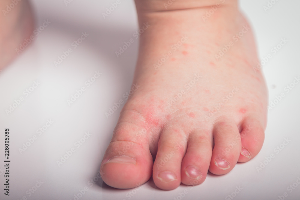 illness, fever, temperature, blisters in a child's arms and feet Stock ...