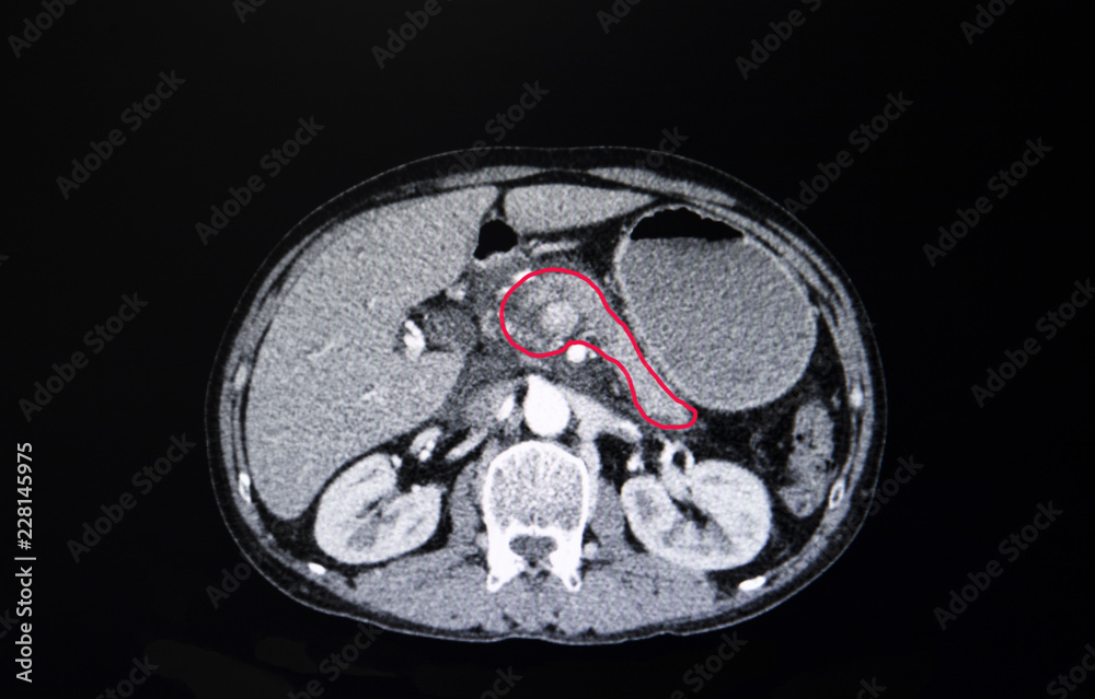 CT of carcinoma of the head of pancreas, pancreatic tumor. Stock Photo ...