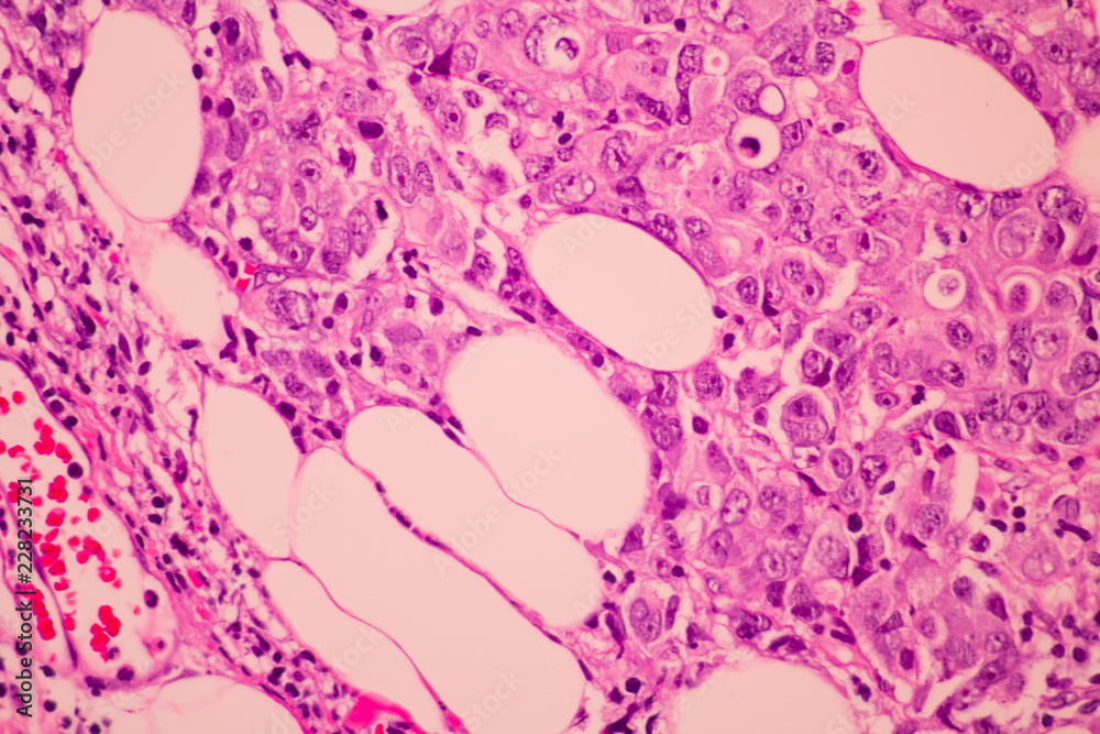 View in microscopic of pathology cross section tissue ductal cell ...