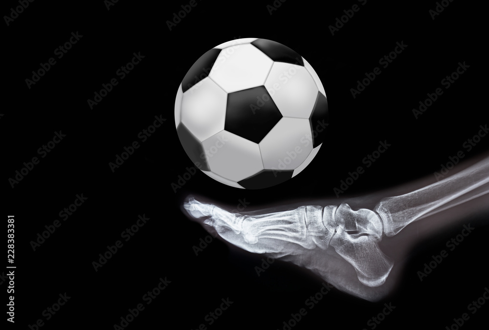 Soccer player's health concept - X-ray normal human's foot with soccer ...