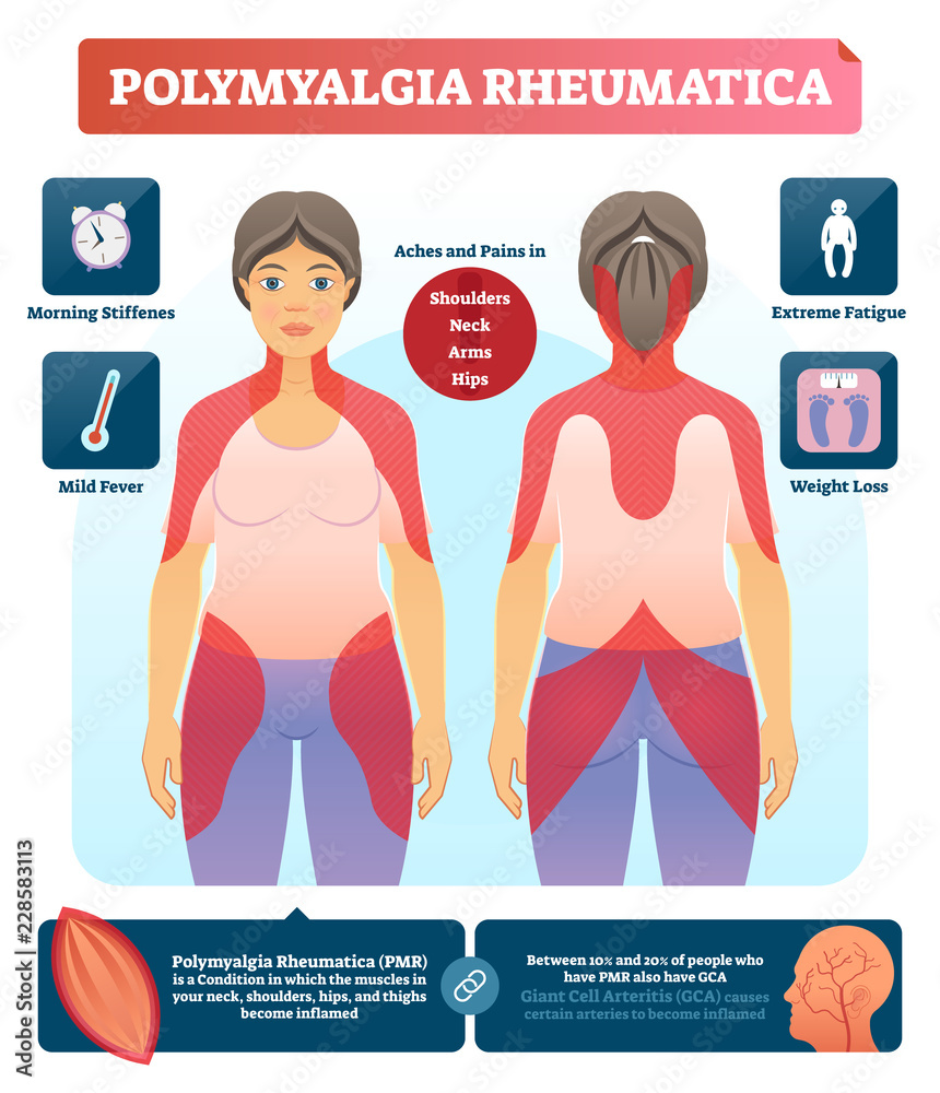 Polymyalgia rheumatica vector illustration. Labeled diagnosis diagram ...