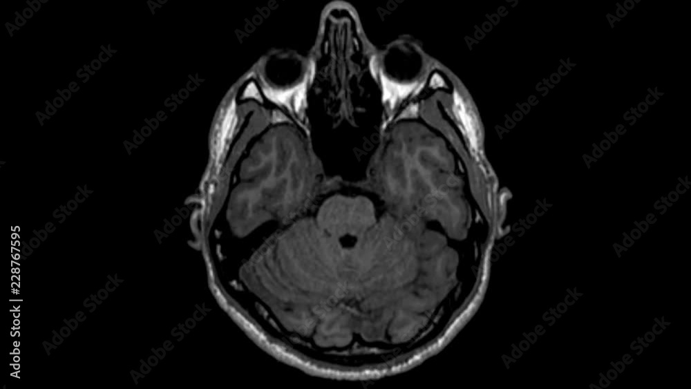MRI radiology scan of the human brain head anatomy, for medical ...