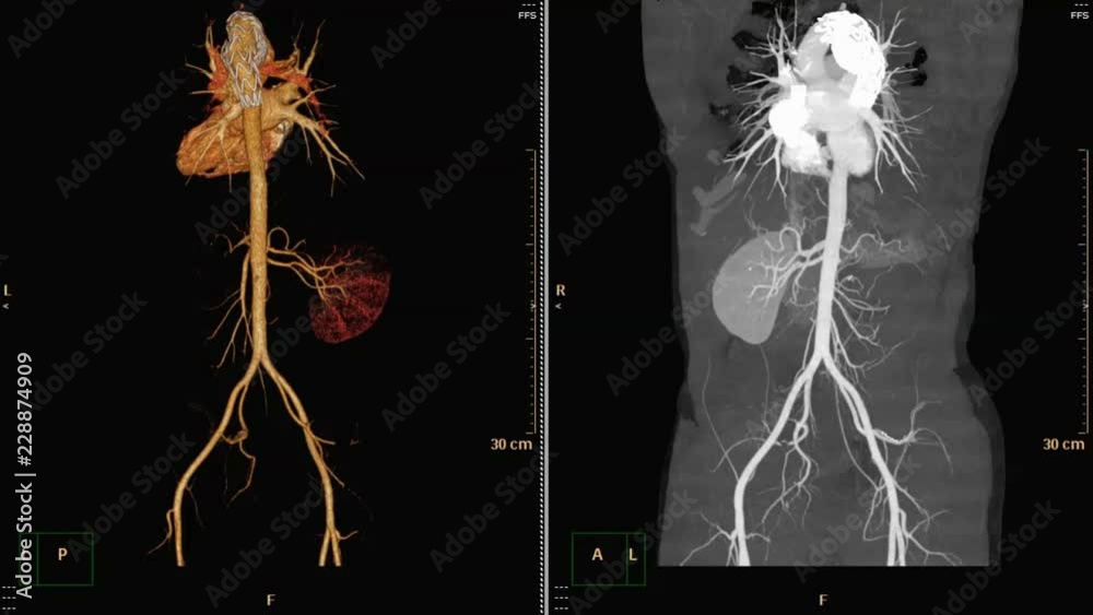 3D rendering and MIP image of CT scan / CTA abdominal aorta with stent ...