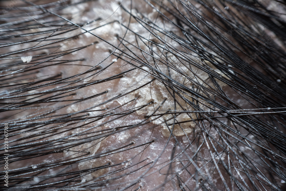 Hair scalp with dandruff and scaly from psoriasis Stock Photo | Adobe Stock