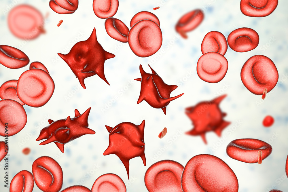 Acanthocytes, abnormal red blood cells with thorn-like projections, 3D ...