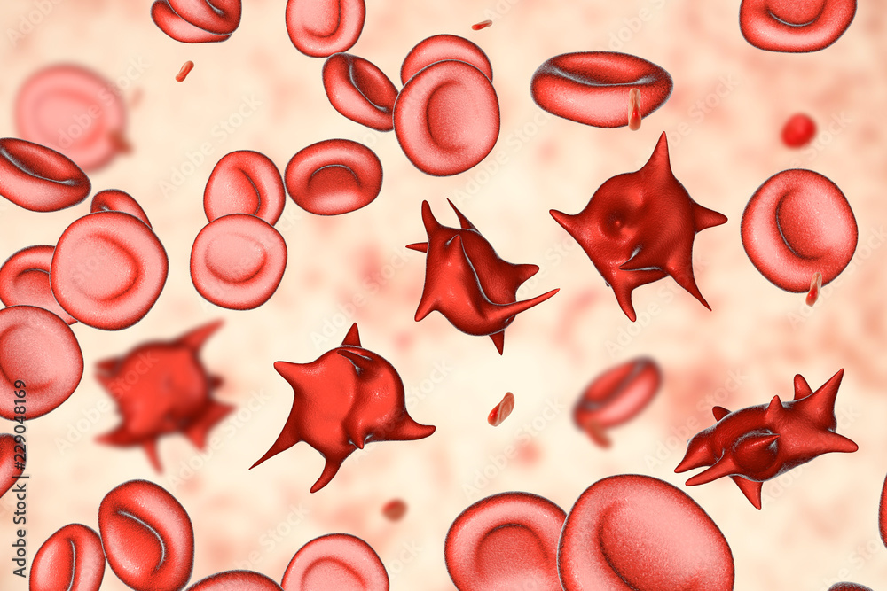 Acanthocytes, abnormal red blood cells with thorn-like projections, 3D ...