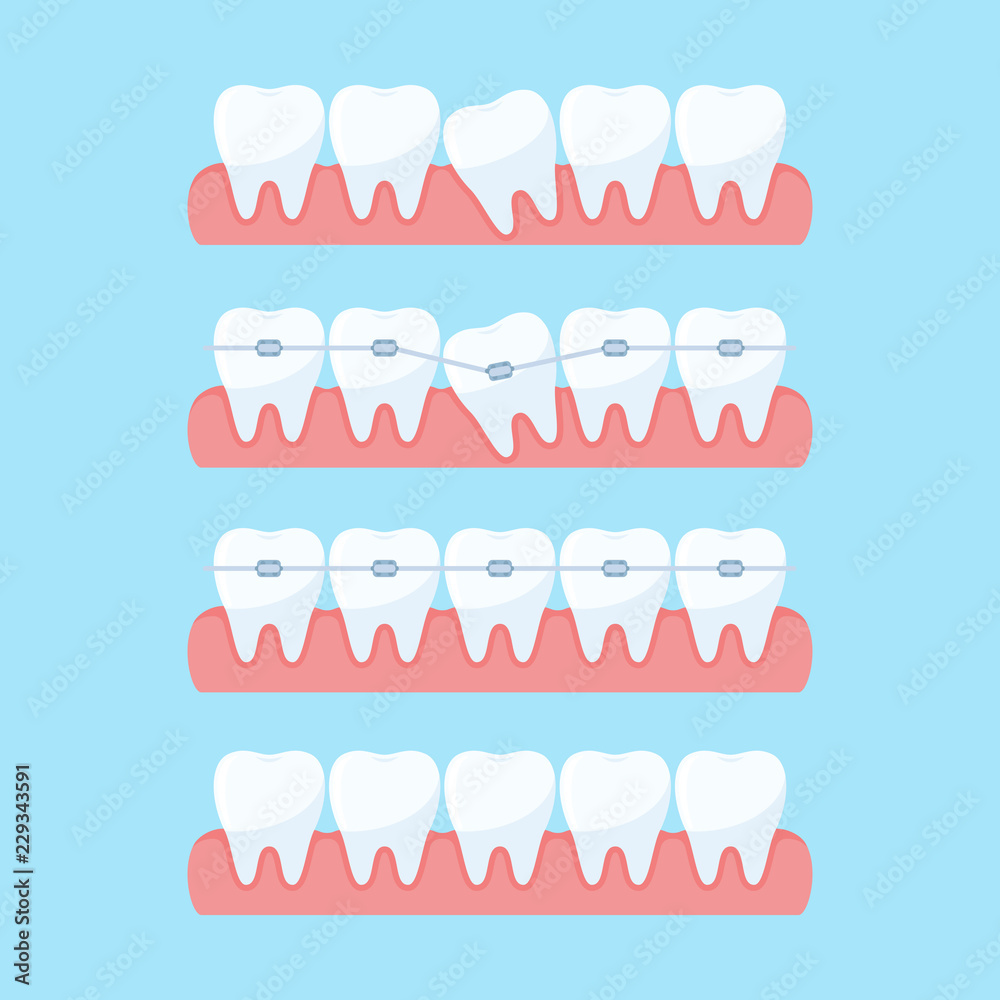 Correction of teeth with orthodontic braces. Stages of teeth alignment ...