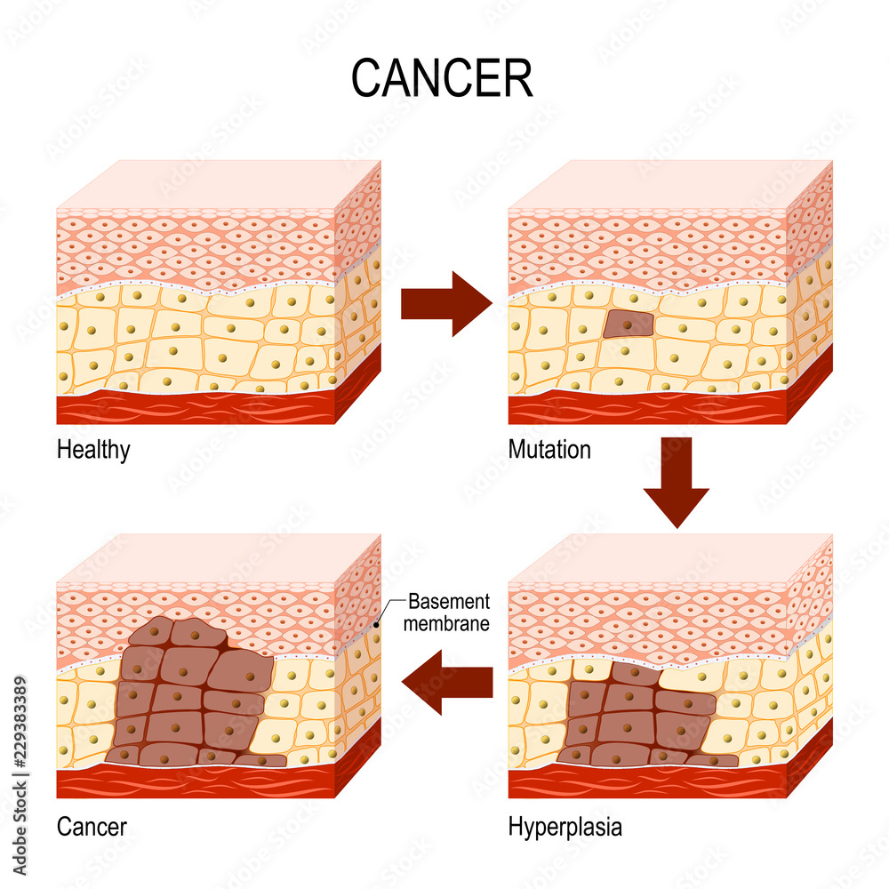 cancer. from Normal cells to Mutation, Hyperplasia, and Malignant tumor ...
