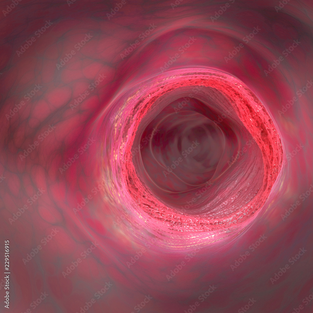 3d illustration of a bowel disease an inflammation inside the colon or ...