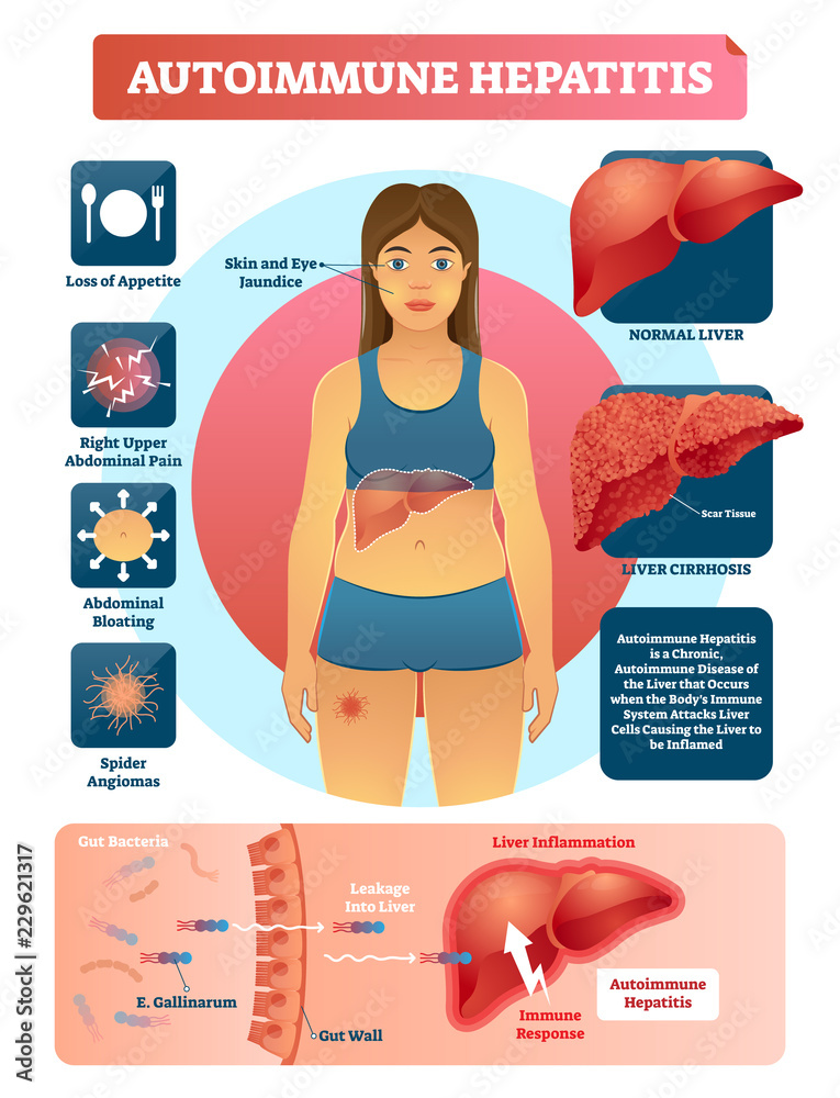 Autoimmune hepatitis vector illustration. Labeled diagram with disease ...