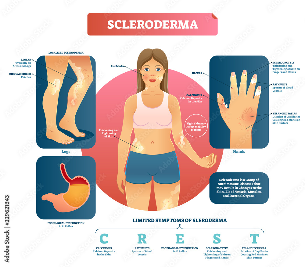 Scleroderma vector illustration. Autoimmune skin and blood disease ...