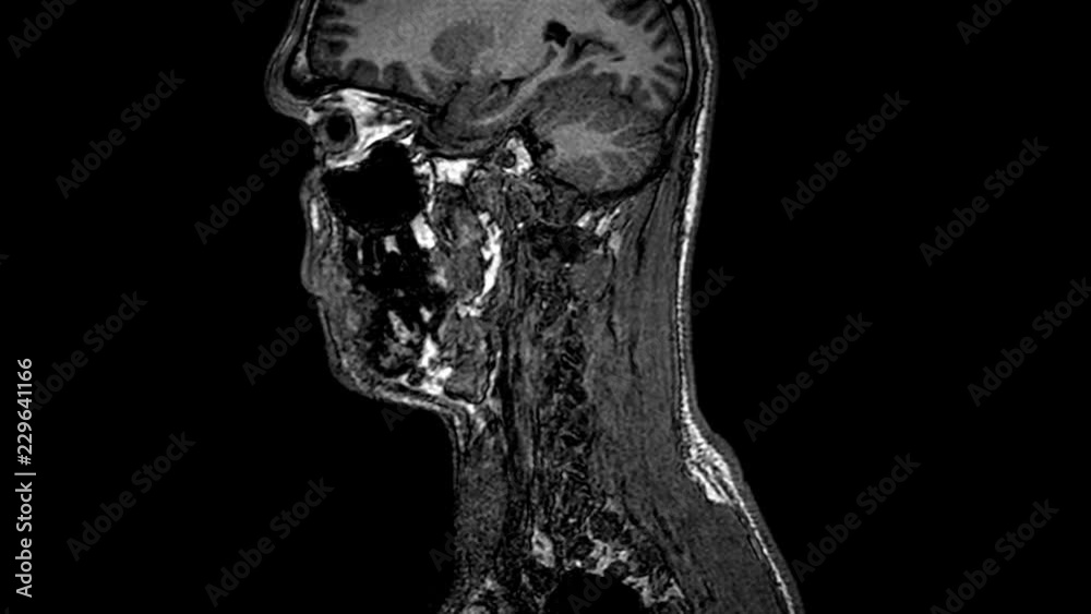 Cervical human spine tomography sagittal T weighted, MRI/Ultrasound ...