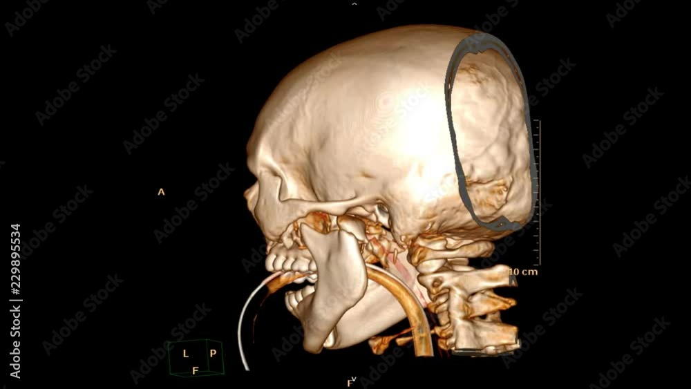 CT SCAN of Skull / facial Bone patient trauma case with endotracheal ...