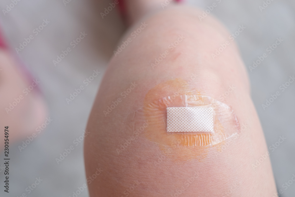 Plaster close the wound at knee caused by accident, Scratches from fall ...