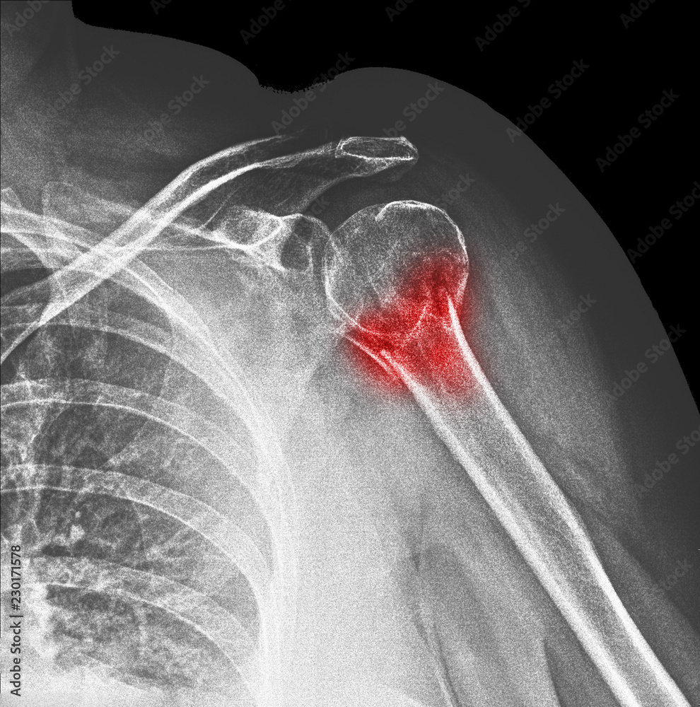 X-ray fracture of the surgical neck of the humerus Stock Photo | Adobe ...