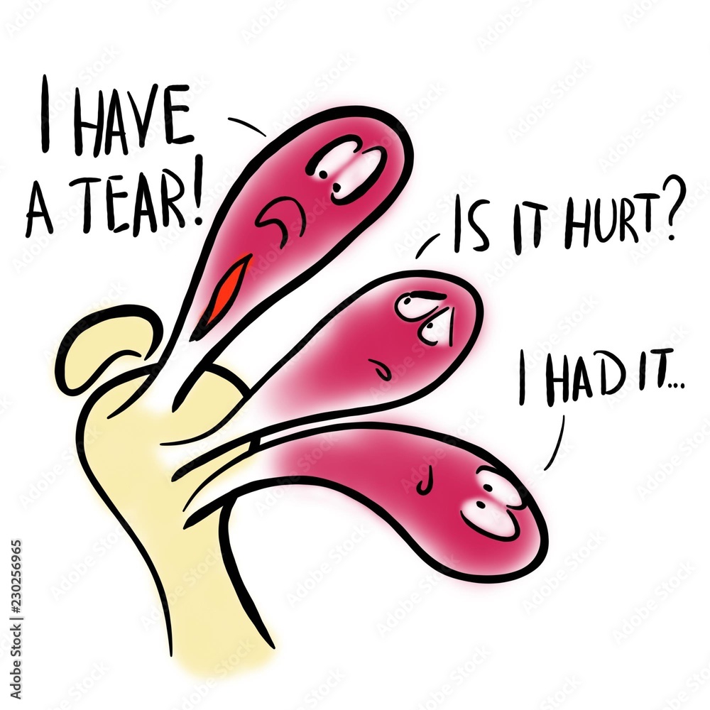 Rotator cuff tear Stock Illustration | Adobe Stock