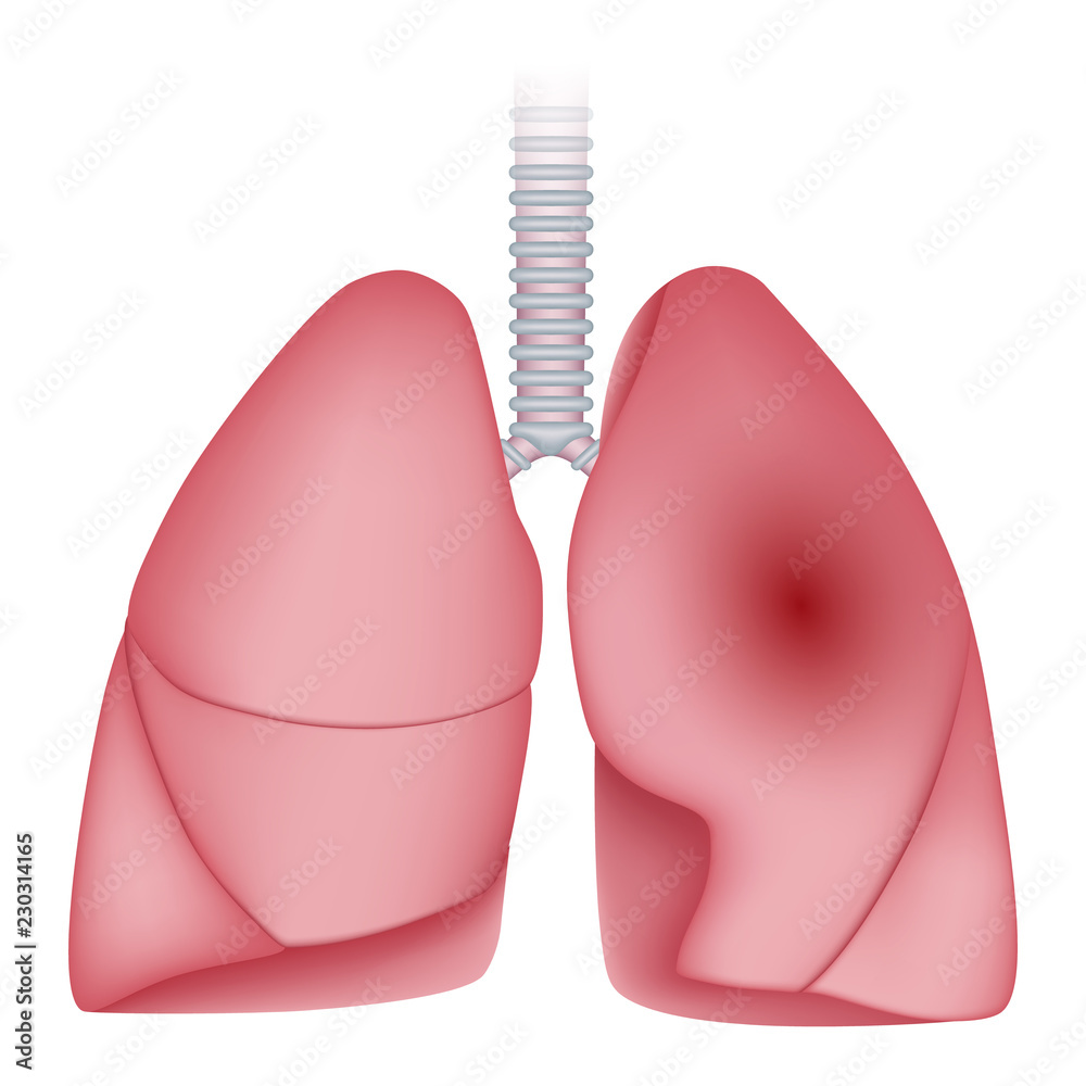 Pneumonia disease lungs icon. Realistic illustration of pneumonia ...